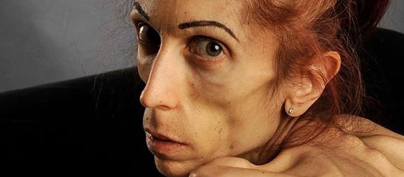 Overcoming Bulimia and Anorexia - Eating Disorder Help and Treatment